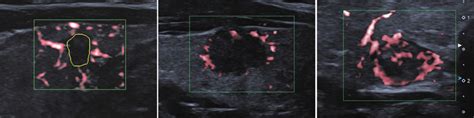 Superb Microvascular Imaging Grading Based On Adler Classification A