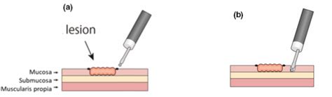 Endoscopic Submucosal Dissection Medigest