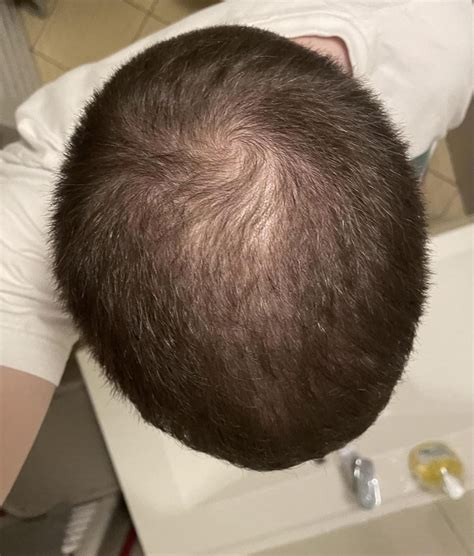 Almost 11 Months On Finasteride Continuing With Only Fin For Now 25m