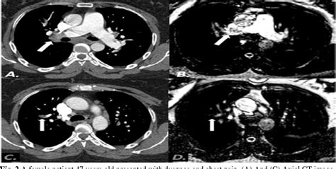 Figure 2 From Role Of Non Contrast Mri In Diagnosis Of Pulmonary