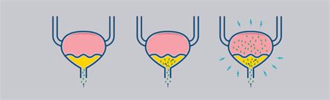 남성의 요로 감염 Tena Korea