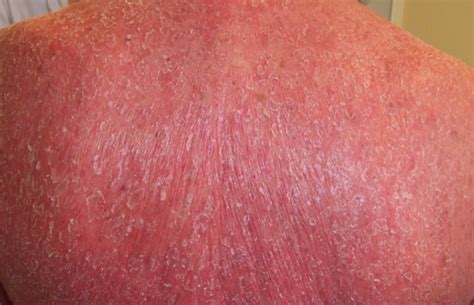 Eritrodermia Manual Digital De Dermatología