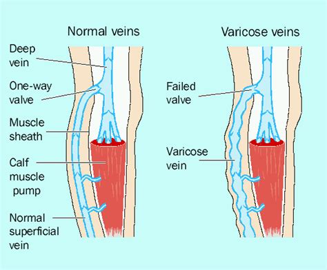 Peroneal Calf Vein