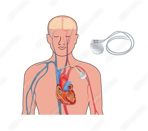 Heart Pacemaker In Work Human Heart Artificial Cardiac Icd 이미지 983537332 일러스트 무료 일러스트 게티이미지뱅크