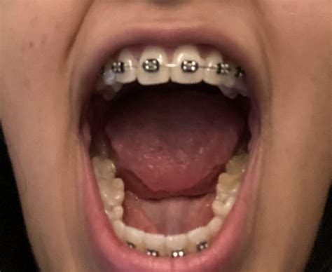 Premolar Extraction Reversal Rorthotropics