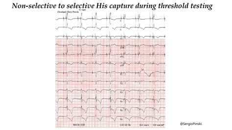 Review Of Conduction System Pacing Pptx