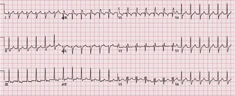 The Intelligence Factory On Linkedin Artificial Intelligence Enabled Smartwatch Used For The