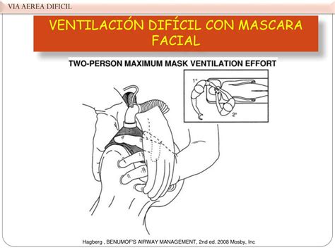 Ppt Manejo De La VÍa AÉrea DifÍcil Powerpoint Presentation Free