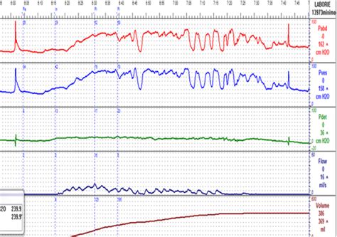 Detrusor Underactivity In Women