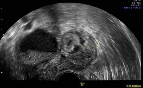 Case Of A Chronic Ectopic Pregnancy Misdiagnosed As Pelvic Inflammatory