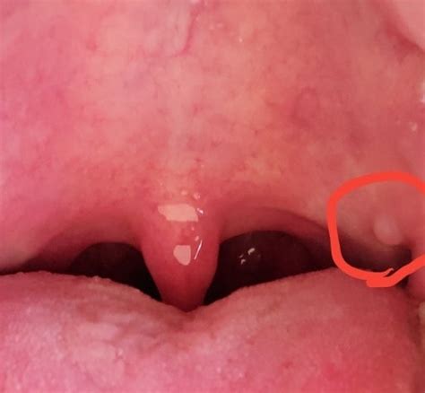 입 안에 혹 같은게 뭘까요 지식in