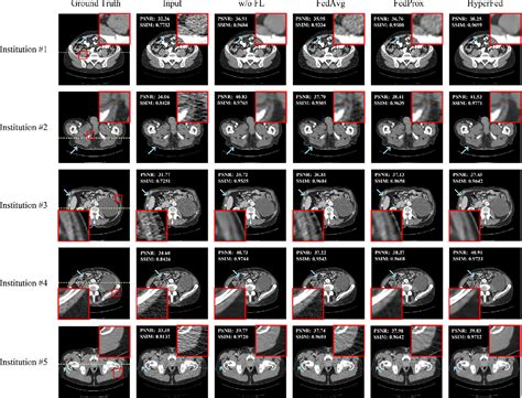 Figure 1 From Hypernetwork Based Personalized Federated Learning For Multi Institutional Ct