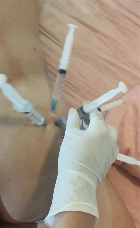 Multiple Injections Video 2 Multiple Injections Video 2