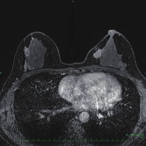 Microscopy Image Of Partial Mastectomy Specimen Of The Left Breast He