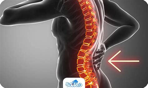 ورزش برای گودی کمر معرفی ۱۰ حرکت اصلاحی برای لوردوز کمر