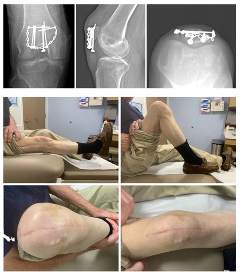 Patella Fracture Classification