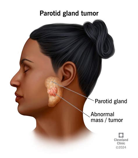 Parotid Swelling Symptoms