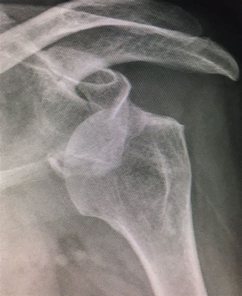 Inferior Glenoid Fracture X Ray At Elvira Pierce Blog
