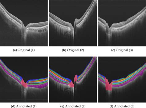 Figure 2 From Improving Oct Image Segmentation Of Retinal Layers By