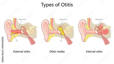 Otitis Ear Infections External Otitis Otitis Media And Internal
