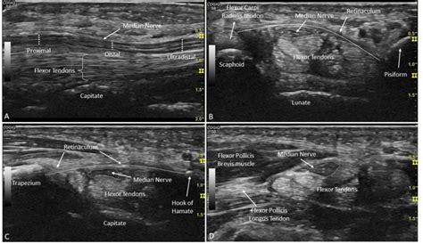 Diagnosis Of Carpal Tunnel Syndrome With Ultrasound Should We Go More