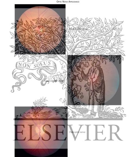 Optic Nerve Appearance