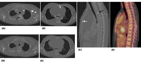 Figure 3 From Reflux Into Vertebral Venous Plexus Due To The Superior