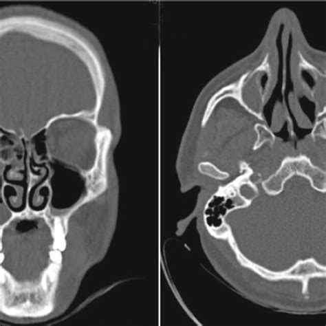 Images Obtained From The New Parameters Bone Window Download