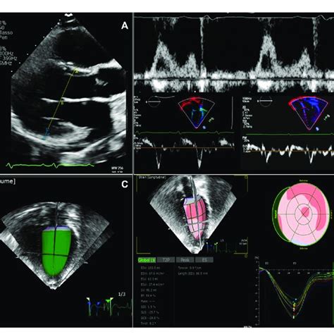 Echocardiographic Examination In Patients With Adpkd And Arpkd A