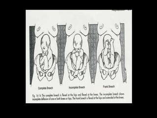 Mechanism Of Labor Ppt