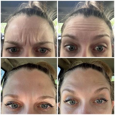 First Time Doing My Own Tox Before And After Rdiycosmeticprocedures