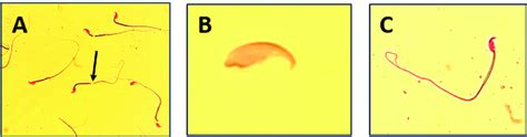 Microscopic Observation Of Sperm Tail Abnormalities 400× A