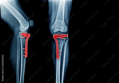 Fracture Tibia Bone And Post Operation Fixation Anterior And Lateral
