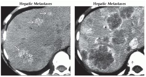Da9 Db1 Hepatic Calcifications Ffu3  Abdominal Key