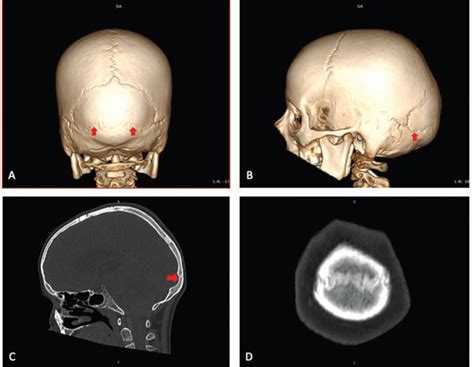 An Aberrant Line On Ct Head The Mendosal Suture Journal Of Neurosciences In Rural Practice
