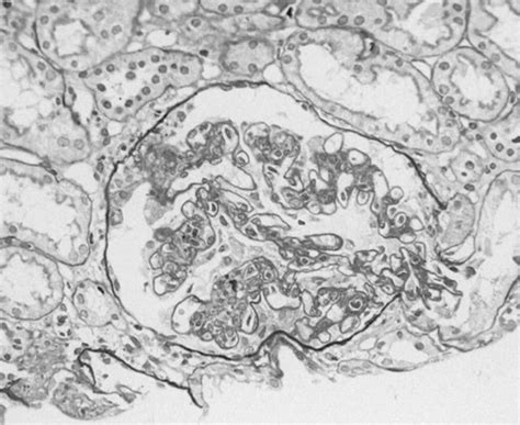 A Pre Treatment Renal Biopsy Specimen Of The Patient Showing