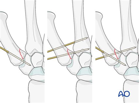 K Wire Fixation For Metacarpal Bennett Fracture