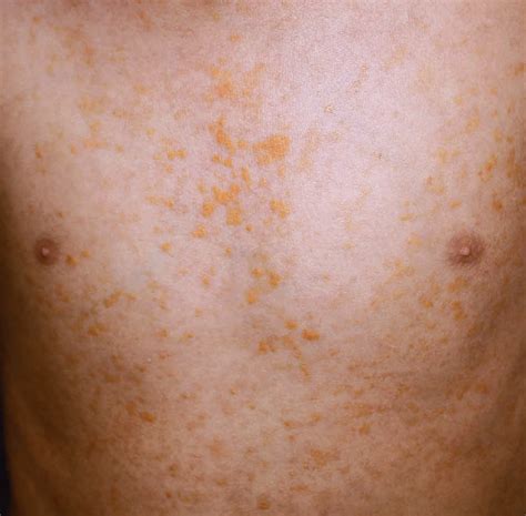 皮膚結節性黄色腫 はなふさ皮膚科 黄色腫 黄色腫症について Nxfjo