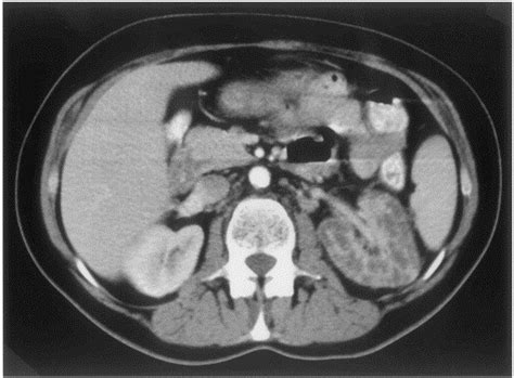 Ct Features Of Renal Infarction European Journal Of Radiology