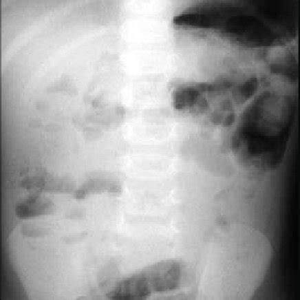 A Erect Abdominal Radiograph Showing Several Air Fluid Levels Download Scientific Diagram
