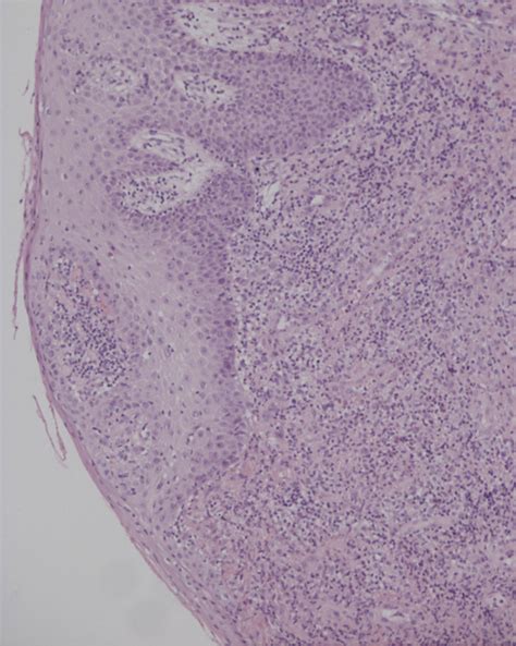 A Case Of Genital Pyoderma Gangrenosum Successfully Treated With Cyclosporine Without Relapse Of