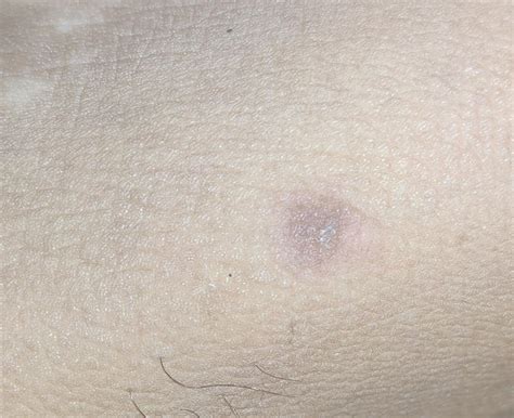 This Random Dark Spots Appearing Randomly On My Body Raskdoctorsmeeee