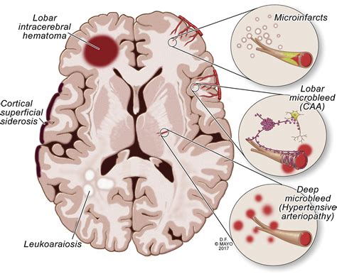 Diagnosis Of Cerebral Amyloid Angiopathy Evolution Of The Boston