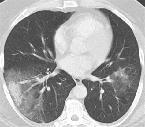 Thorax Radiology Assistent E