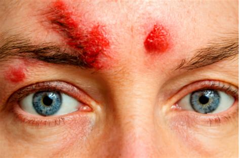 Shingles In The Eye Symptoms Causes And Treatment Options