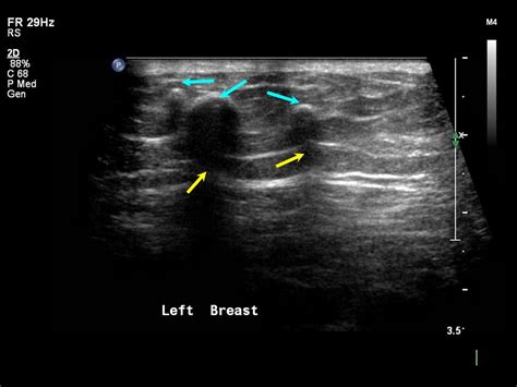 Atlas Of Breast Cancer Early Detection