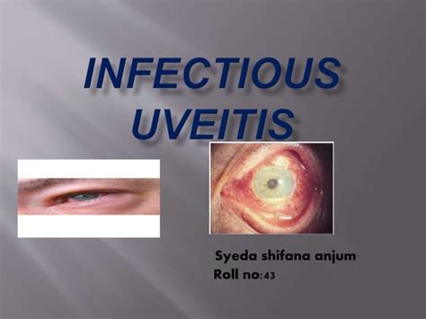 Infectious Uveitis Pptx