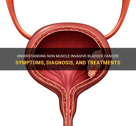 Understanding Non Muscle Invasive Bladder Cancer Symptoms Diagnosis