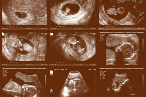 TYPES OF PREGNANCY SCANS My Baby And I Scan