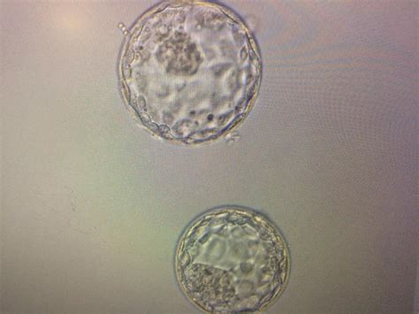 Ahmad Awartani On Linkedin 2 Frozen Embryos On Blastocyst Stage After Thawing Ready To Be